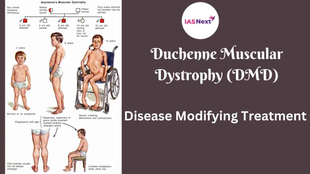 Duchenne Muscular Dystrophy (DMD) : Disease Modifying Treatment
